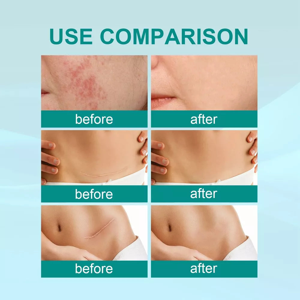 Vacuum Cupping Massage Therapy Device For All Parts Of The Body